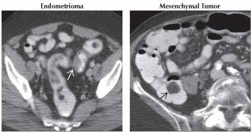 DA7-DB1-Solitary_Colonic_Filling_Defect-FFU5.gif | Abdominal Key