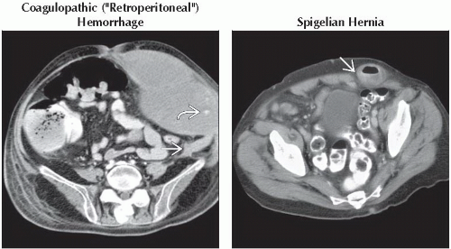 DA7-DB2-Acute_Left_Lower_Quadrant_Pain-FFU13.gif | Abdominal Key