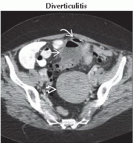 DA7-DB2-Acute_Left_Lower_Quadrant_Pain-FFU2.gif | Abdominal Key
