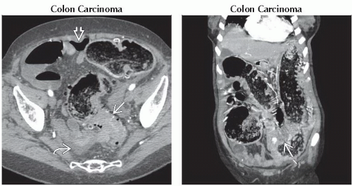 DA7-DB2-Acute_Left_Lower_Quadrant_Pain-FFU3.gif | Abdominal Key