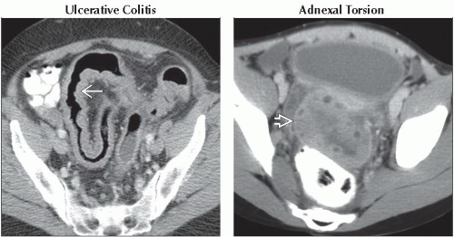 DA7-DB2-Acute_Left_Lower_Quadrant_Pain-FFU6.gif | Abdominal Key