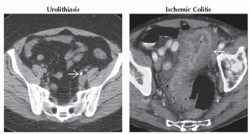 DA7-DB2-Acute_Left_Lower_Quadrant_Pain-FFU8.gif | Abdominal Key