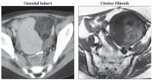 DA7-DB2-Acute_Left_Lower_Quadrant_Pain-FFU9.gif | Abdominal Key