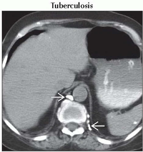 DA8-DB1-Multiple_Splenic_Calcifications-FFU2.gif | Abdominal Key