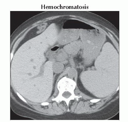 DA8-DB2-Diffuse_Increased_Attenuation_Spleen-FFU1.gif | Abdominal Key