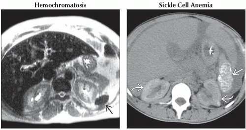 DA8-DB2-Diffuse_Increased_Attenuation_Spleen-FFU3.gif | Abdominal Key
