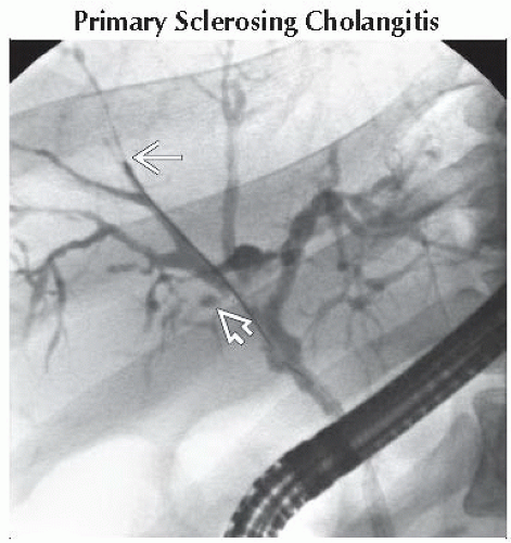 DA9-DB1-Dysmorphic_Liver_with_Abnormal_Bile_Ducts-FFU2.gif | Abdominal Key