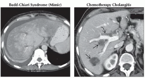 DA9-DB1-Dysmorphic_Liver_with_Abnormal_Bile_Ducts-FFU5.gif | Abdominal Key