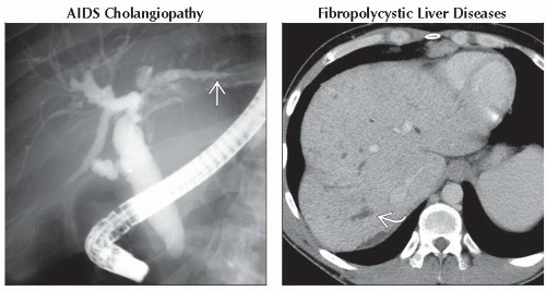 DA9-DB1-Dysmorphic_Liver_with_Abnormal_Bile_Ducts-FFU6.gif | Abdominal Key