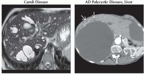 DA9-DB1-Dysmorphic_Liver_with_Abnormal_Bile_Ducts-FFU7.gif | Abdominal Key