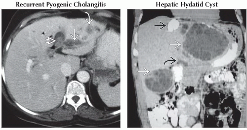 DA9-DB1-Dysmorphic_Liver_with_Abnormal_Bile_Ducts-FFU8.gif | Abdominal Key