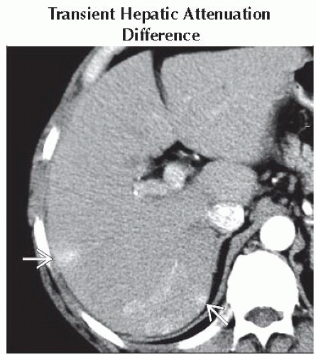 DA9-DB1-Focal_Hyperperfusion_Abnormality_THAD_or_THID-FFU1.gif ...