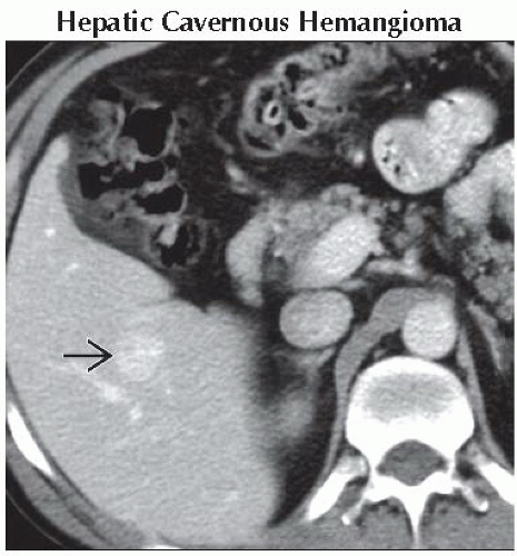 DA9-DB1-Focal_Hypervascular_Liver_Lesion-FFU1.gif | Abdominal Key