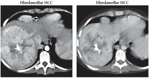 DA9-DB1-Focal_Hypervascular_Liver_Lesion-FFU10.gif | Abdominal Key