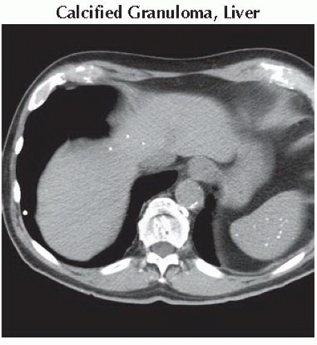 DA9-DB1-Hepatic_Calcifications-FFU1.gif | Abdominal Key