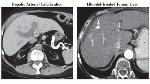 DA9-DB1-Hepatic_Calcifications-FFU4.gif | Abdominal Key