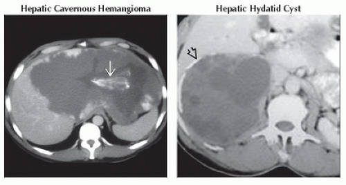 DA9-DB1-Hepatic_Calcifications-FFU5.gif | Abdominal Key
