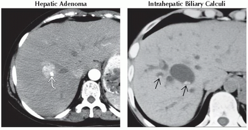 DA9-DB1-Hepatic_Calcifications-FFU7.gif | Abdominal Key