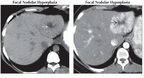 DA9-DB1-Hepatic_Calcifications-FFU8.gif | Abdominal Key