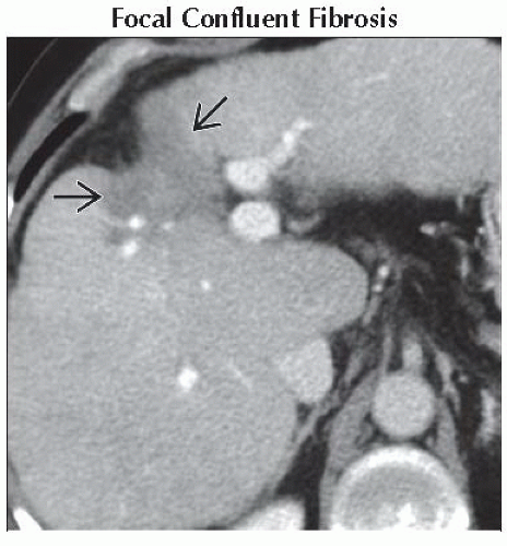 DA9-DB1-Liver_Mass_with_Capsular_Retraction-FFU1.gif | Abdominal Key
