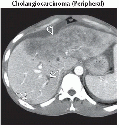 DA9-DB1-Liver_Mass_with_Capsular_Retraction-FFU2.gif | Abdominal Key