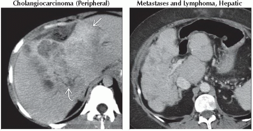 DA9-DB1-Liver_Mass_with_Capsular_Retraction-FFU3.gif | Abdominal Key