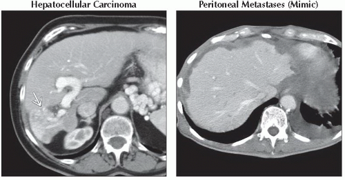 DA9-DB1-Liver_Mass_with_Capsular_Retraction-FFU4.gif | Abdominal Key