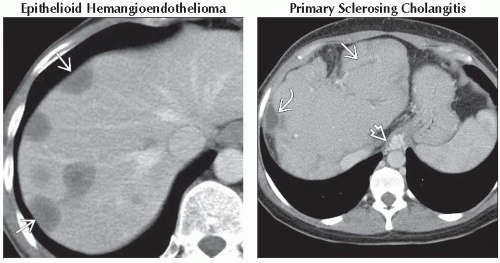 DA9-DB1-Liver_Mass_with_Capsular_Retraction-FFU5.gif | Abdominal Key