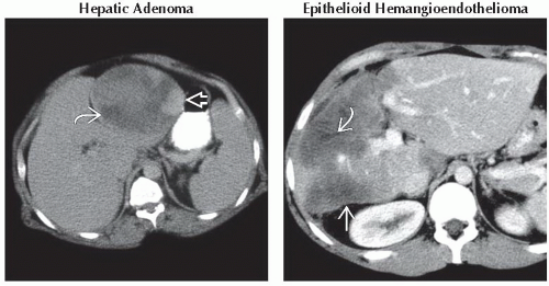 DA9-DB1-Liver_Mass_with_Central_or_Eccentric_Scar-FFU5.gif | Abdominal Key