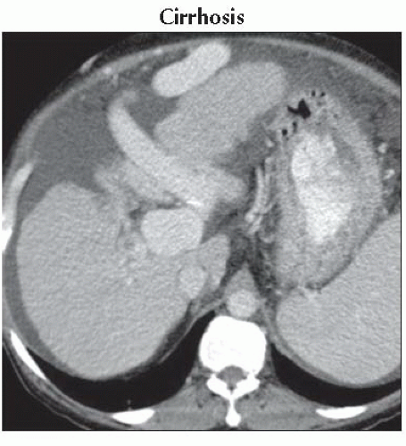 DA9-DB1-Widened_Hepatic_Fissures-FFU1.gif | Abdominal Key
