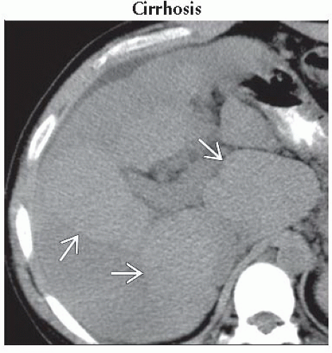 DA9-DB1-Widened_Hepatic_Fissures-FFU2.gif | Abdominal Key