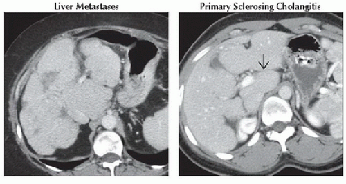 DA9-DB1-Widened_Hepatic_Fissures-FFU4.gif | Abdominal Key