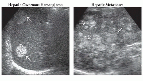 DA9-DB2-Focal_Hepatic_Echogenic_Lesion_Acoustic_Shadowing-FFU3.gif ...