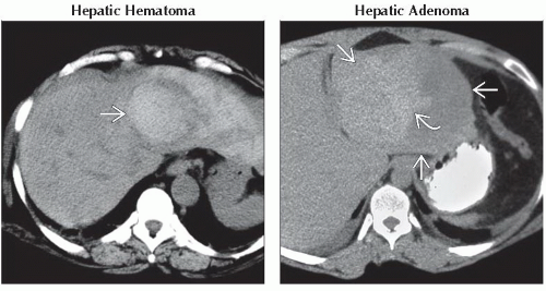 DA9-DB2-Focal_Hyperdense_Hepatic_Mass_on_Nonenhanced_CT-FFU5.gif ...