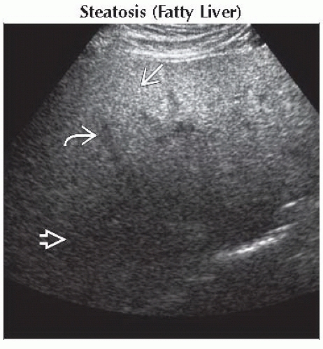 DA9-DB2-Hyperechoic_Liver_Diffuse-FFU1.gif | Abdominal Key