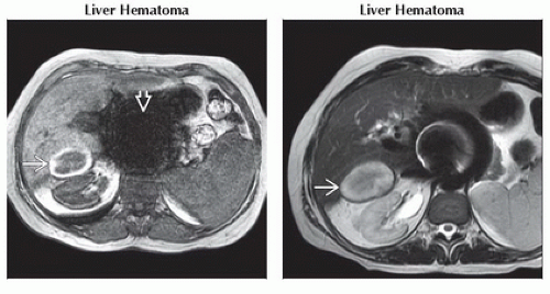DA9-DB2-Hyperintense_Liver_Lesions_T1WI-FFU5.gif | Abdominal Key