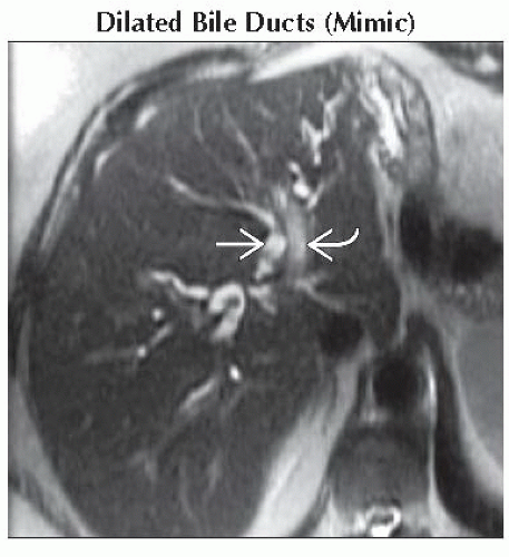 DA9-DB2-Periportal_Lucency_or_Edema-FFU1.gif | Abdominal Key