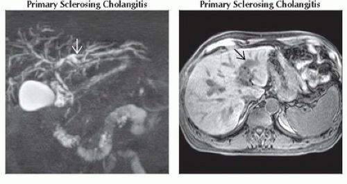 DA9-DB2-Periportal_Lucency_or_Edema-FFU10.gif | Abdominal Key