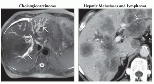 DA9-DB2-Periportal_Lucency_or_Edema-FFU13.gif | Abdominal Key