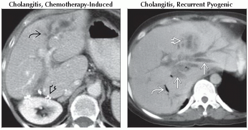 DA9-DB2-Periportal_Lucency_or_Edema-FFU14.gif | Abdominal Key