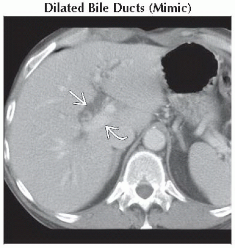 DA9-DB2-Periportal_Lucency_or_Edema-FFU2.gif | Abdominal Key