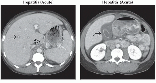 DA9-DB2-Periportal_Lucency_or_Edema-FFU4.gif | Abdominal Key