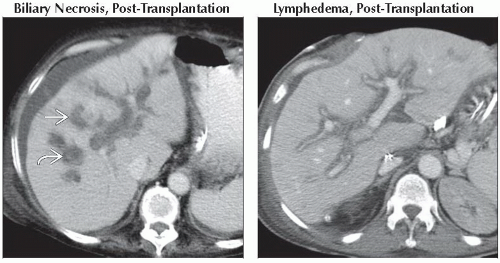 DA9-DB2-Periportal_Lucency_or_Edema-FFU6.gif | Abdominal Key