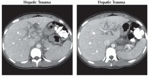 DA9-DB2-Periportal_Lucency_or_Edema-FFU7.gif | Abdominal Key