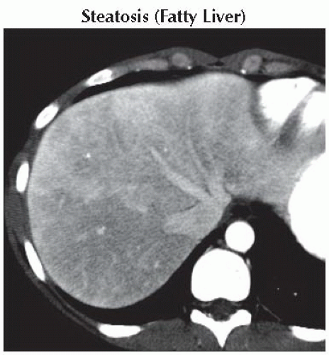 DA9-DB2-Widespread_Low_Attenuation_within_Liver-FFU1.gif | Abdominal Key