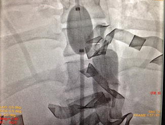 Damage Control Laparotomy Abdominal Key
