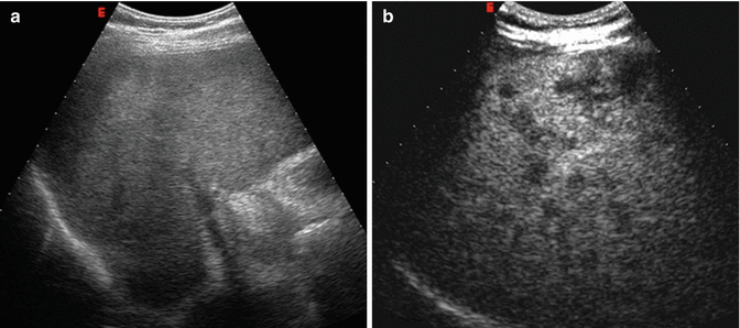 Diagnostic Value Of Ultrasound In Metastatic Liver Cancer Abdominal Key