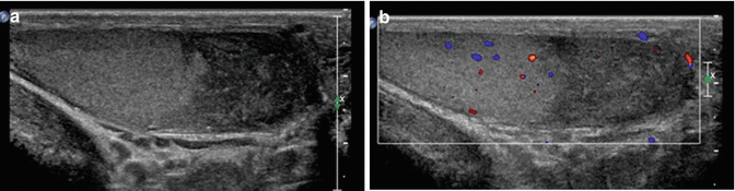 The Testicles: Trauma, Inflammation and Testicular Torsion | Abdominal Key