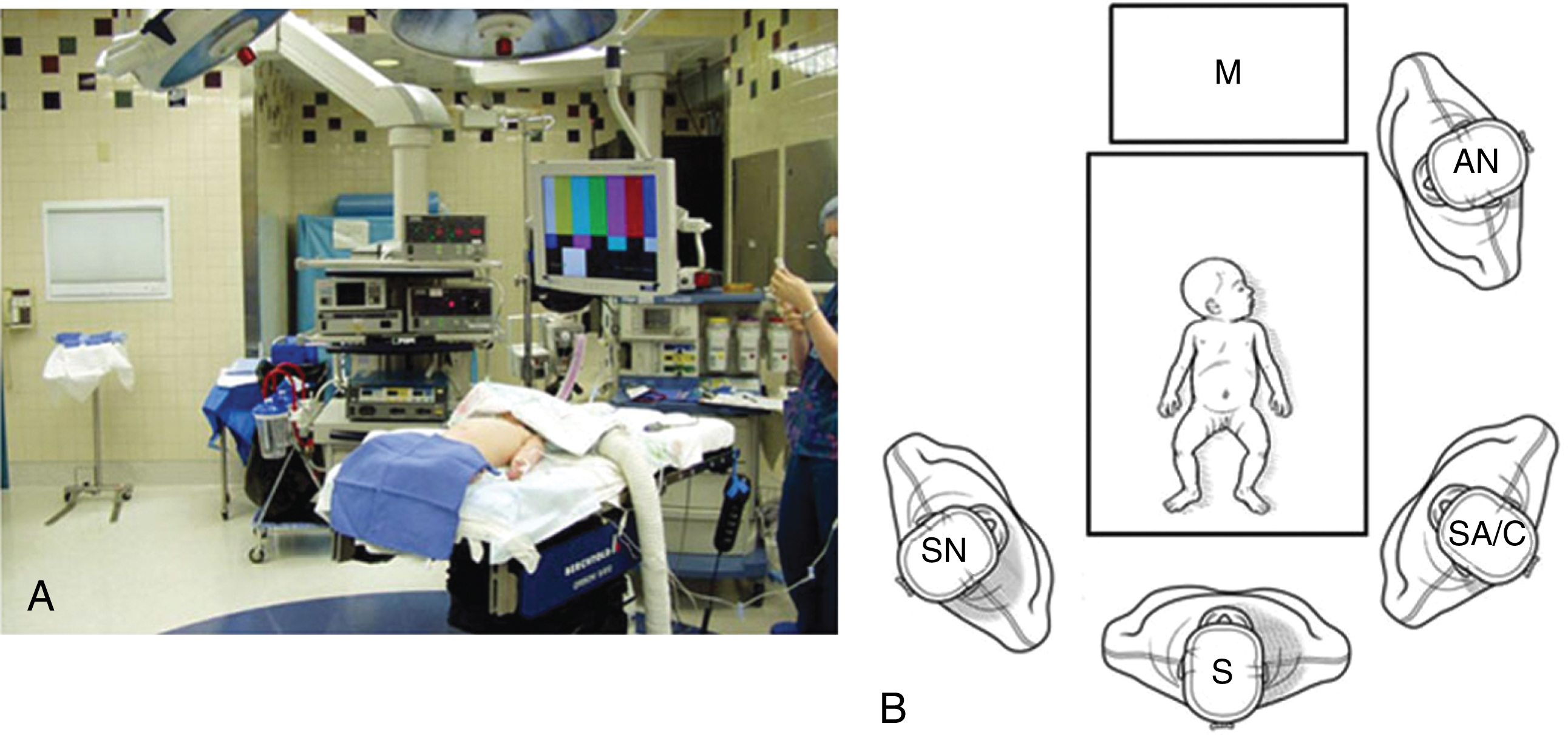Laparoscopic Fundoplication Abdominal Key