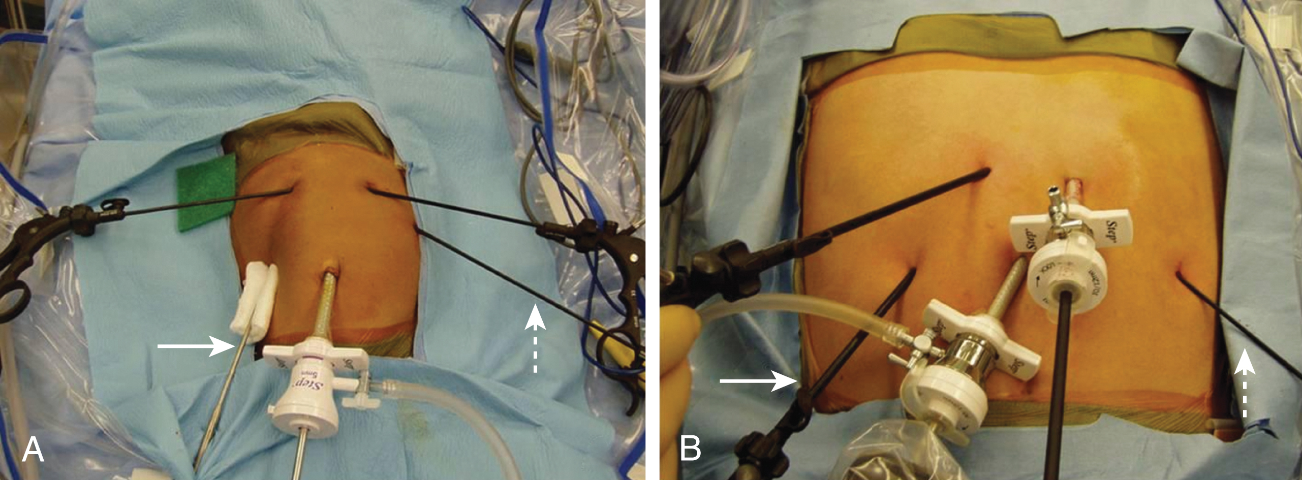 Laparoscopic Fundoplication Abdominal Key